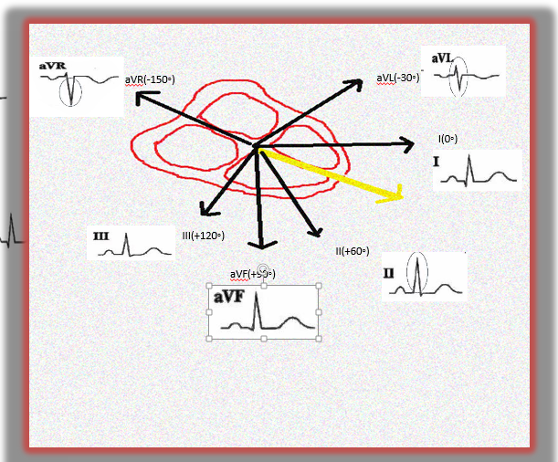 Why should I pay attention to the augmented vector right (aVR) EKG lead ...