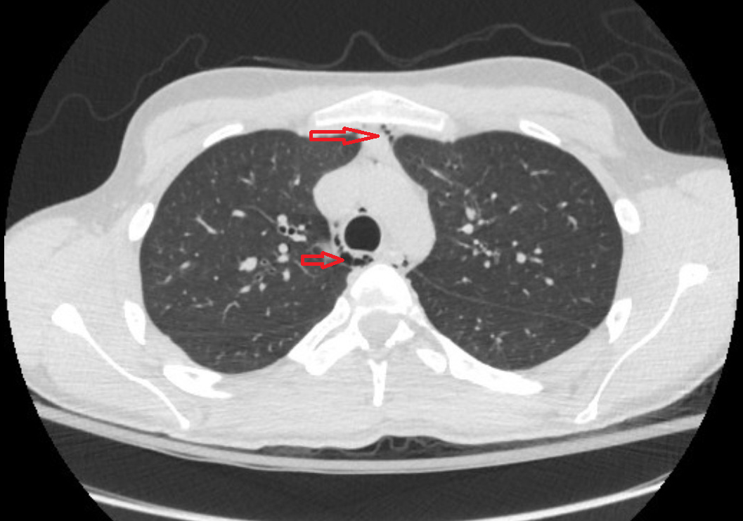 A previously healthy young man with chest pain is admitted to my ...